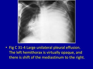 31 shift of the mediastinum | PPTX