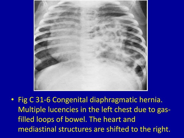 31 shift of the mediastinum | PPT