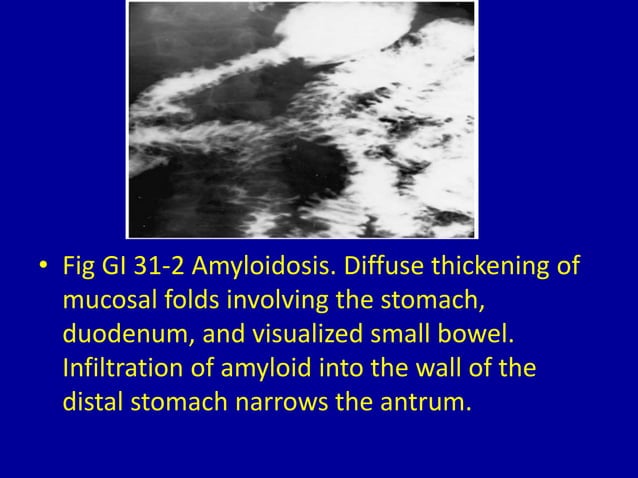 31 simultaneous fold thickening of the stomach and | PPTX