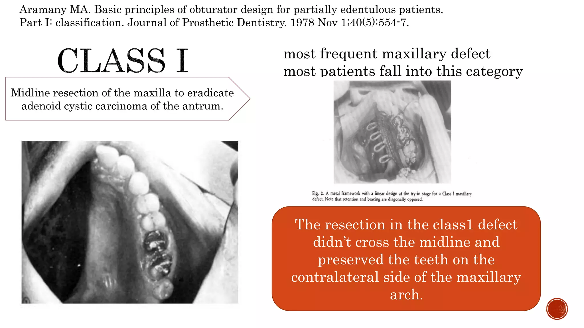 obturators / prosthodontic management of maxillectomy - part 1 | PPTX