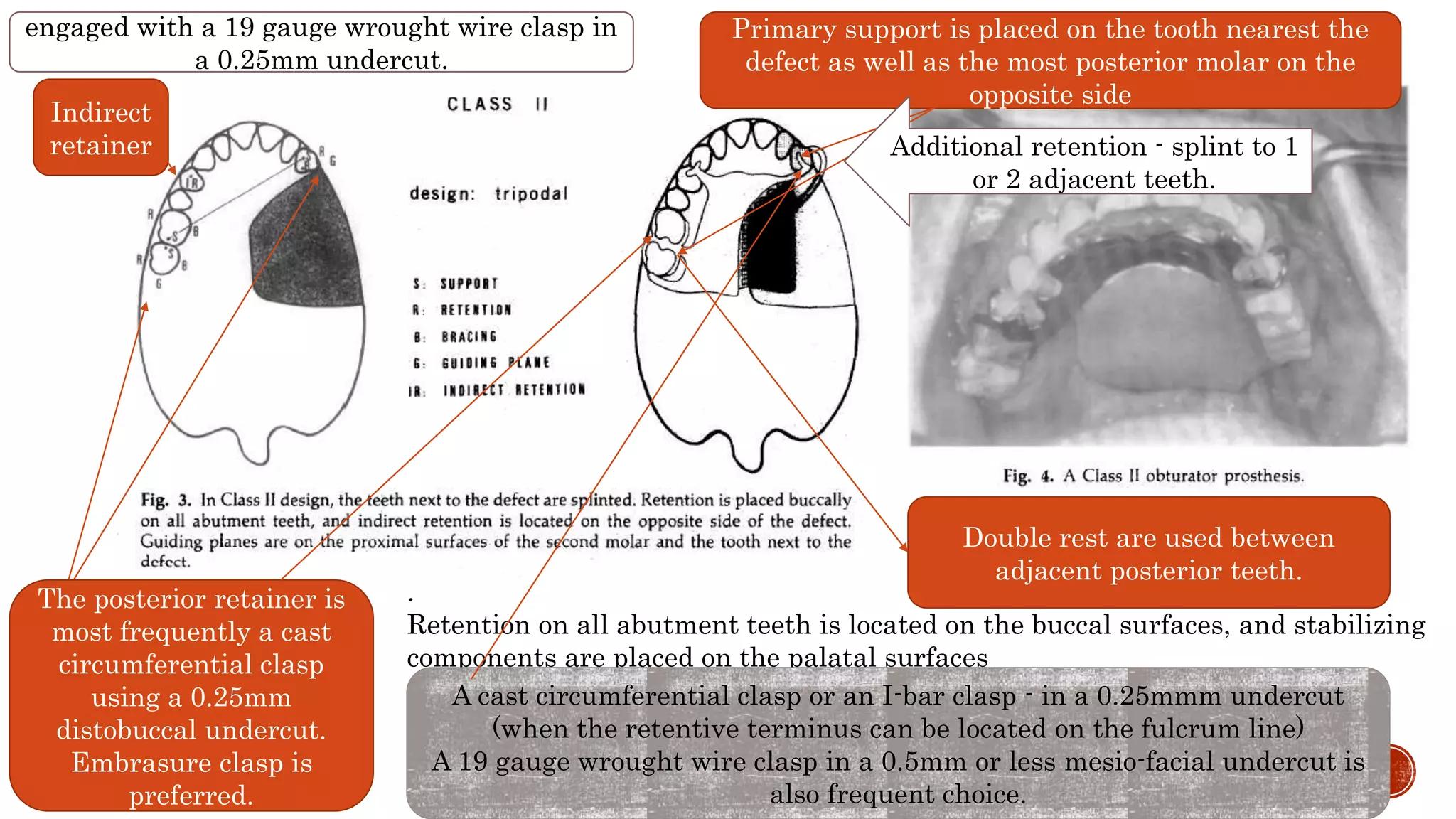 obturators / prosthodontic management of maxillectomy - part 1 | PPTX