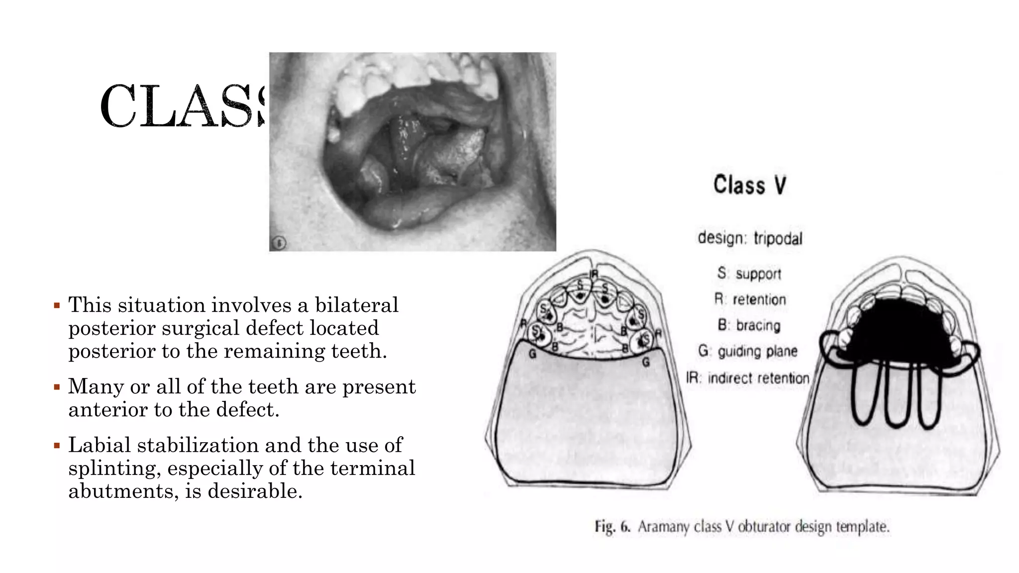 obturators / prosthodontic management of maxillectomy - part 1 | PPTX