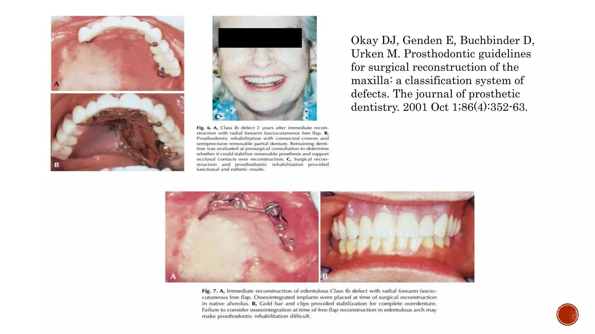 obturators / prosthodontic management of maxillectomy - part 1 | PPTX
