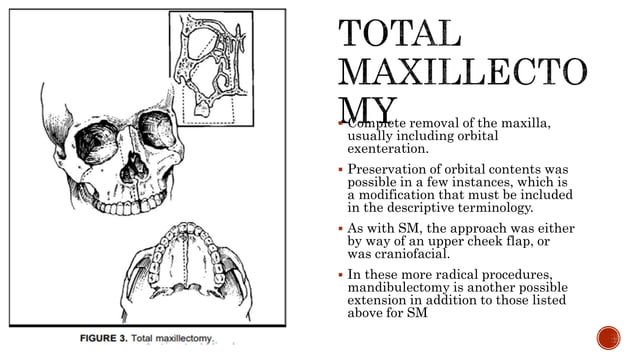 obturators / prosthodontic management of maxillectomy - part 1 | PPT