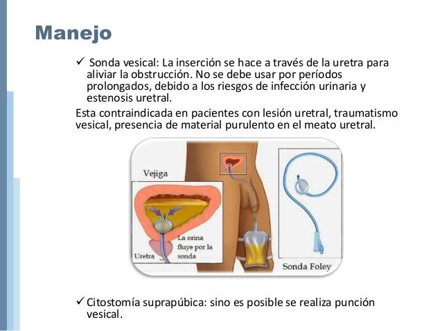 32 Retención Urinaria