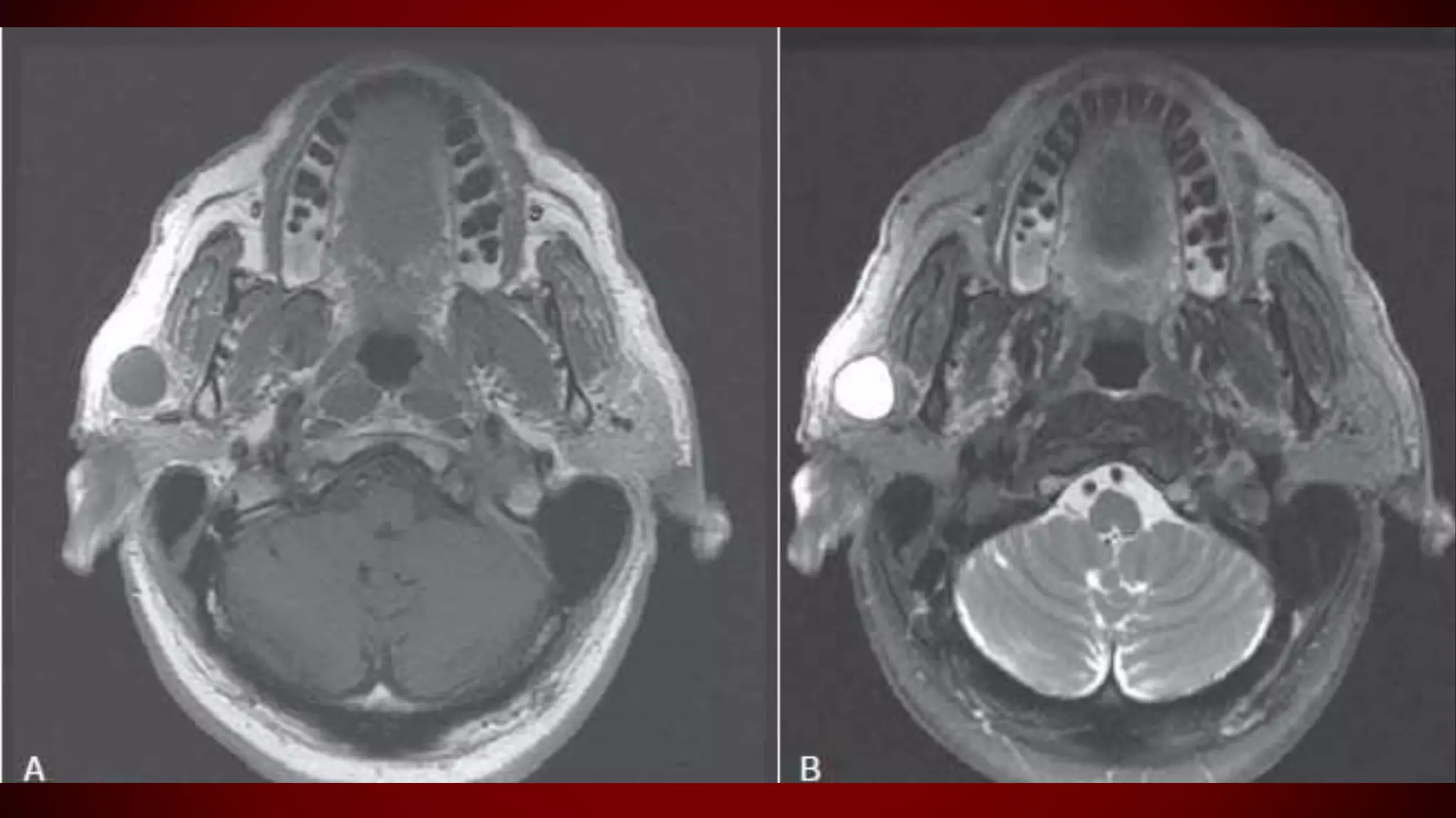 Radiographic Features of Normal and Abnormal Salivary Glands | PPTX