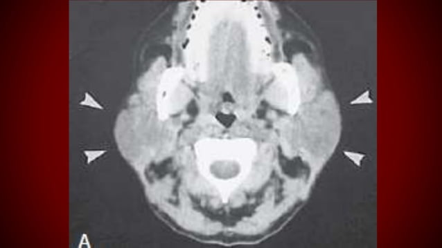 Radiographic Features of Normal and Abnormal Salivary Glands | PPTX ...