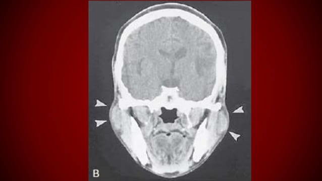 Radiographic Features of Normal and Abnormal Salivary Glands | PPTX ...
