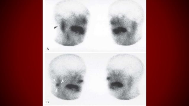 Radiographic Features of Normal and Abnormal Salivary Glands | PPTX ...