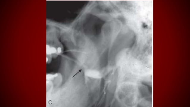 Radiographic Features of Normal and Abnormal Salivary Glands | PPTX ...