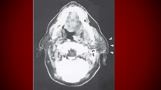 Radiographic Features of Normal and Abnormal Salivary Glands | PPTX ...