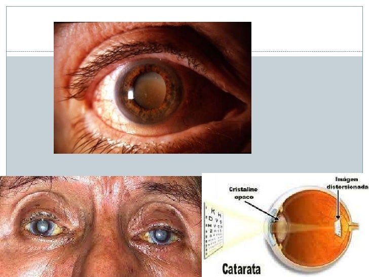 perdida crónica de la visión