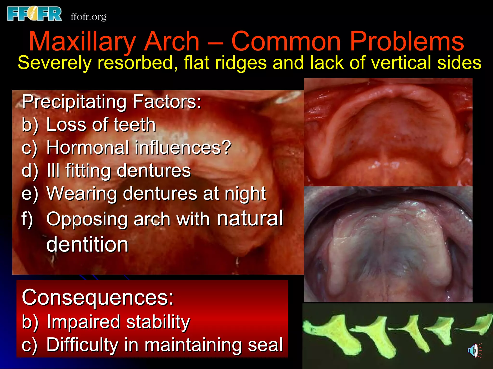 32.preprosthetic surgical procedures (n) | PPT