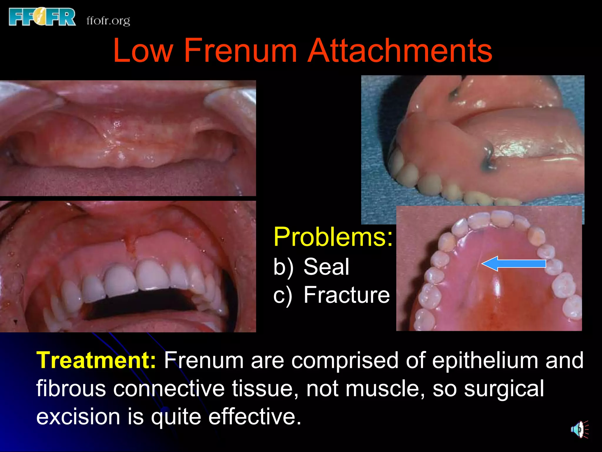 32.preprosthetic surgical procedures (n) | PPT