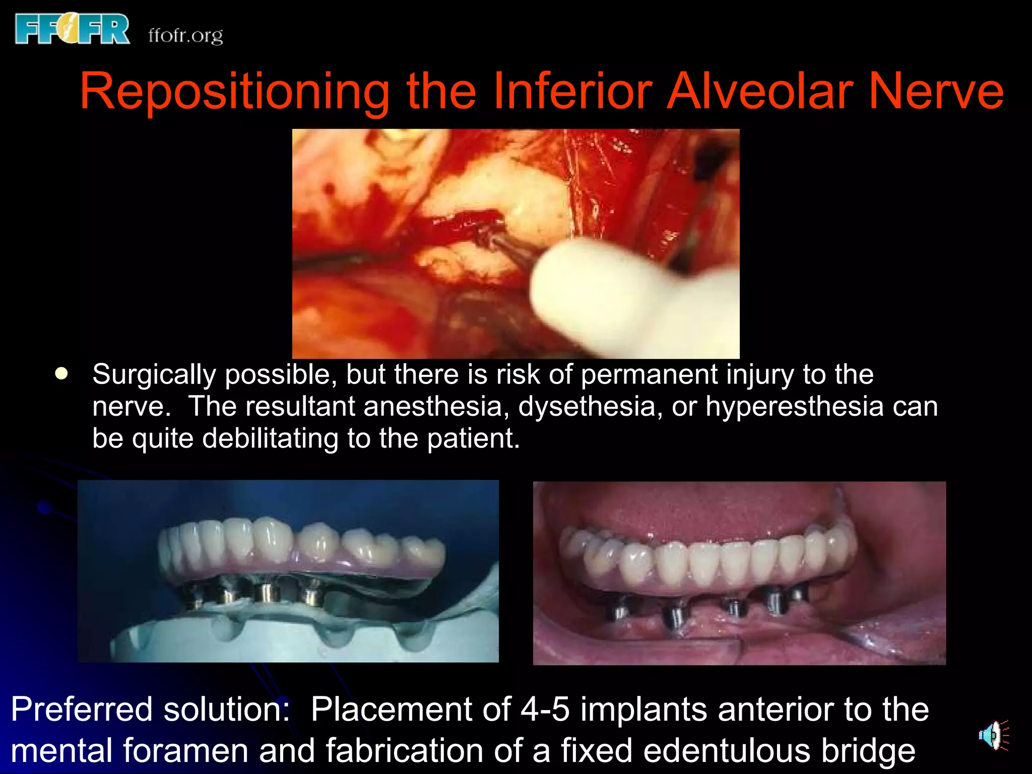 32.preprosthetic surgical procedures (n) | PPT