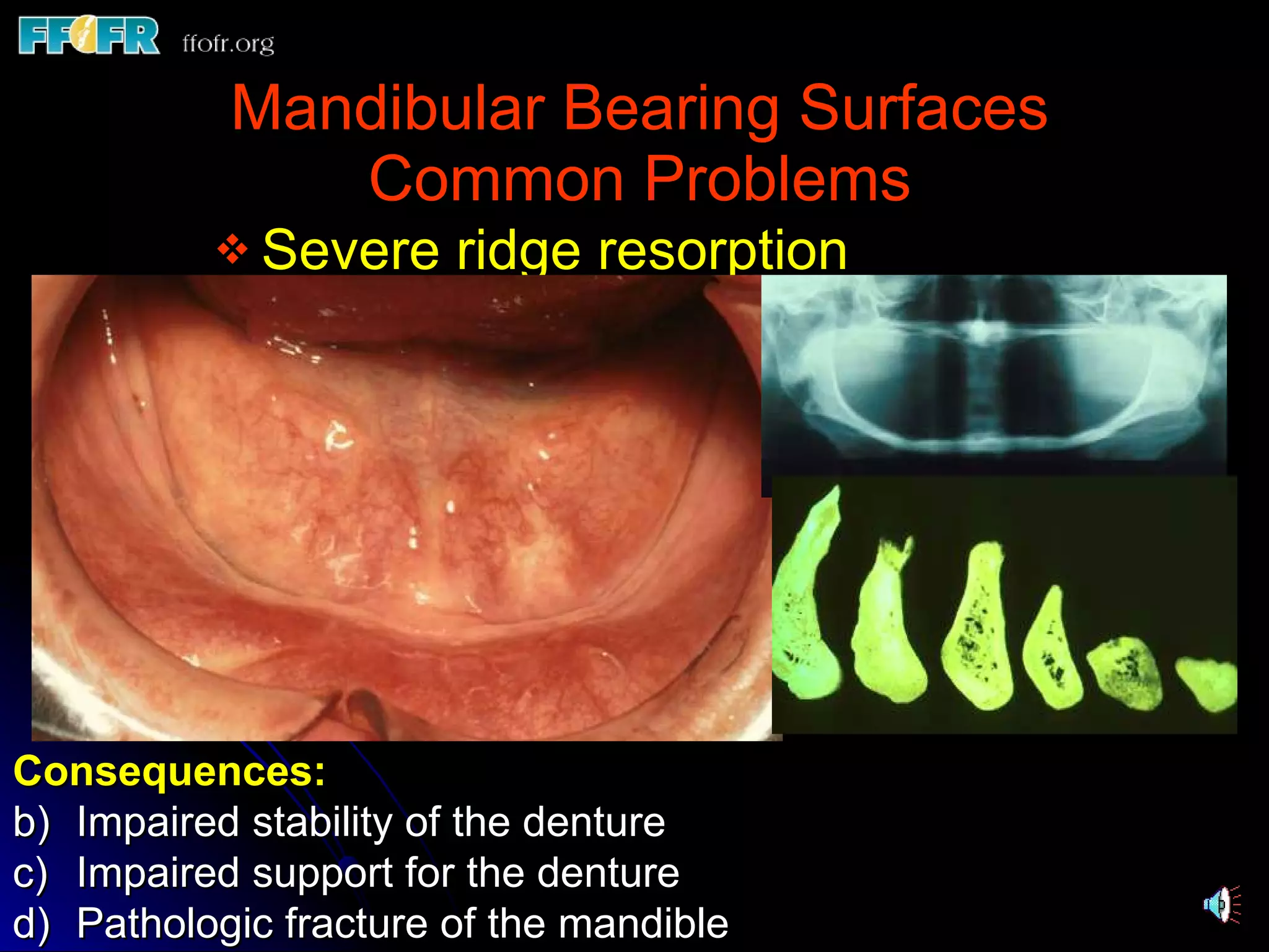 32.preprosthetic surgical procedures (n) | PPT