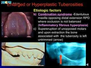 Fibrous Maxillary Tuberosity