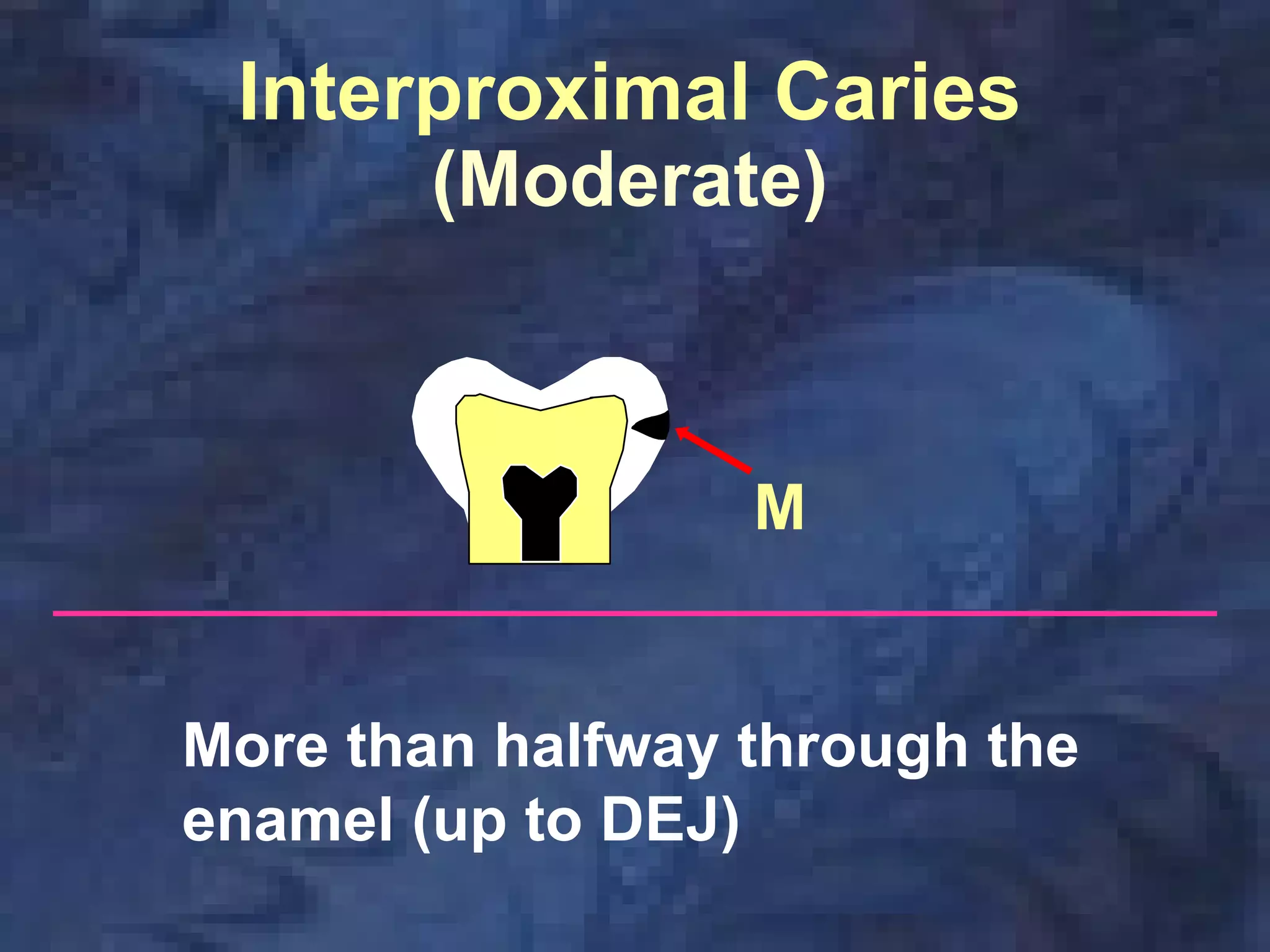 radiographic-caries-diagnosis | PDF