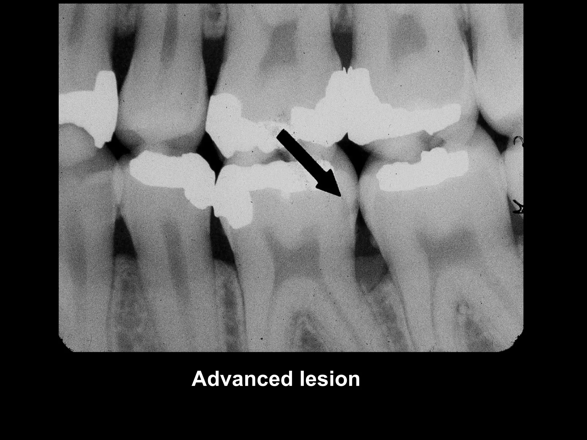 radiographic-caries-diagnosis | PDF