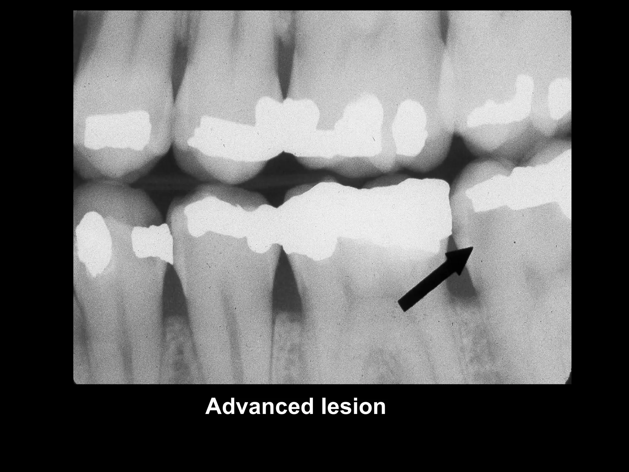 radiographic-caries-diagnosis | PDF