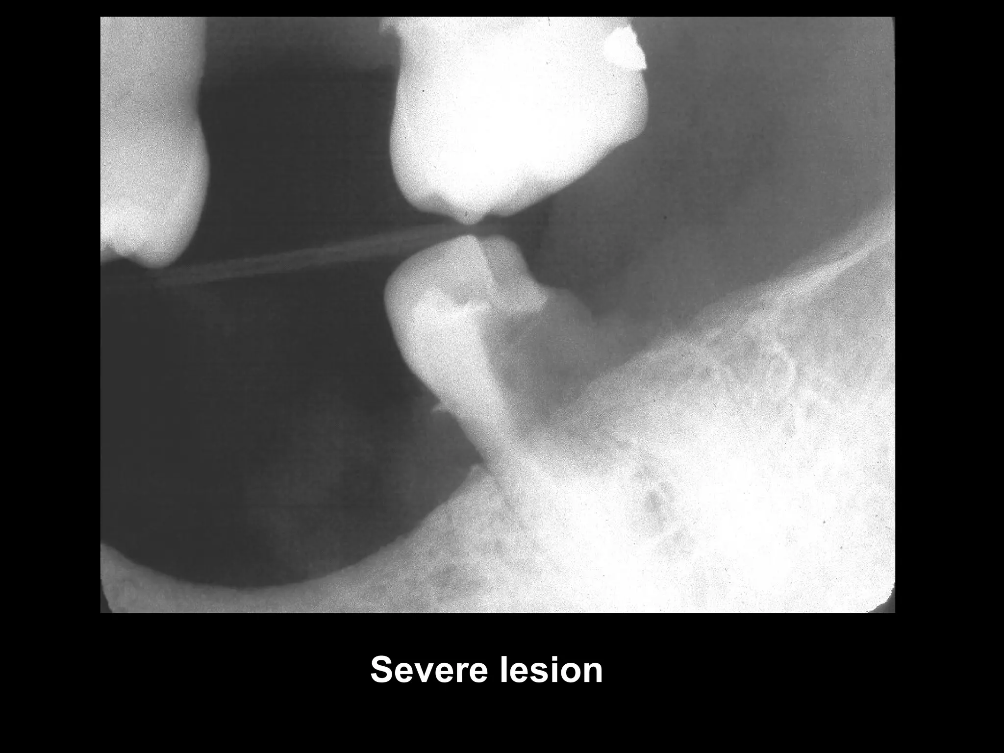 radiographic-caries-diagnosis | PDF