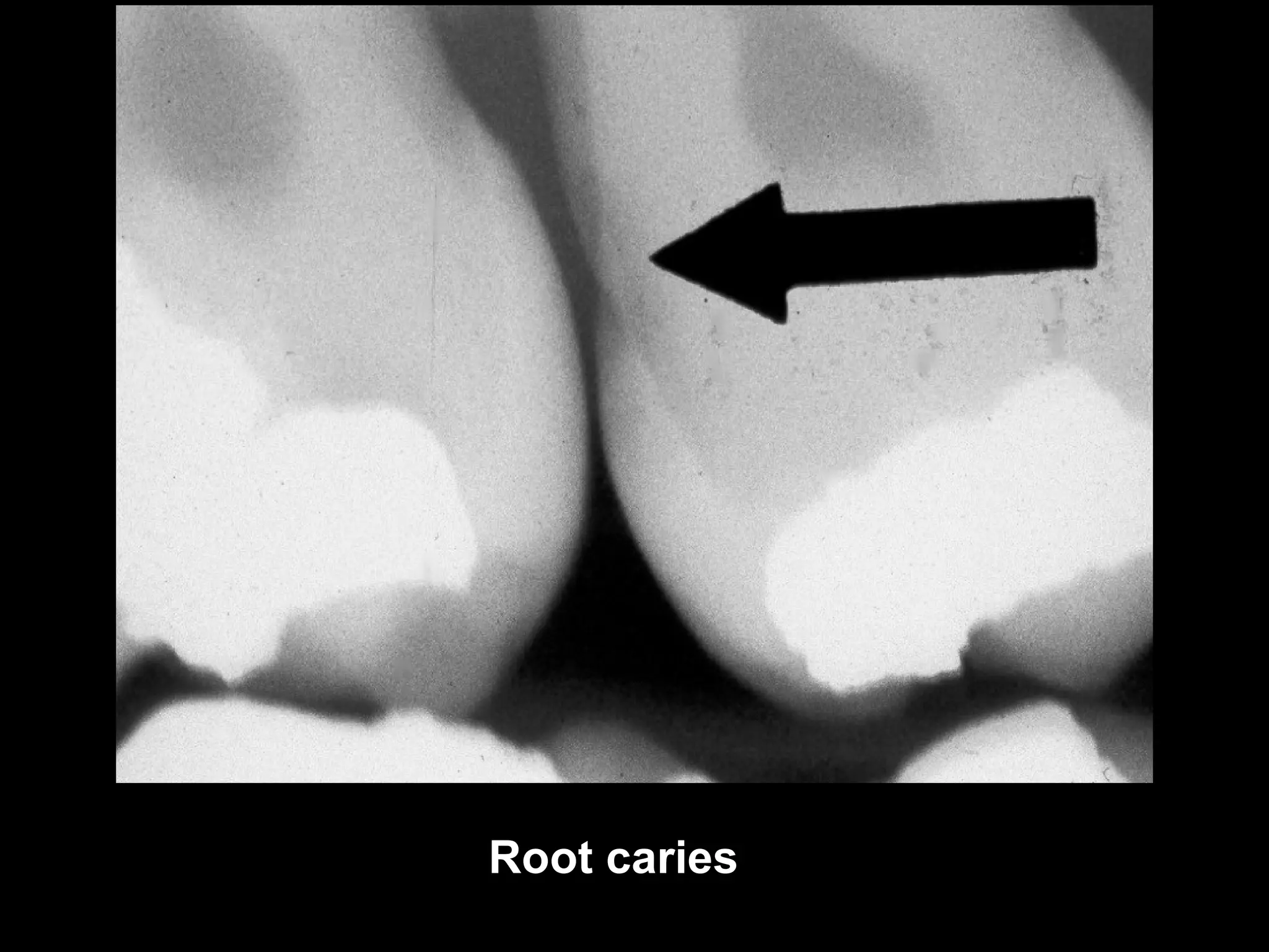 radiographic-caries-diagnosis | PDF