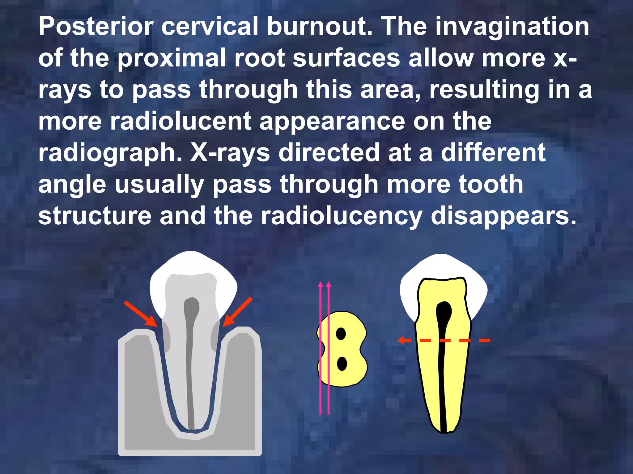 radiographic-caries-diagnosis | PDF
