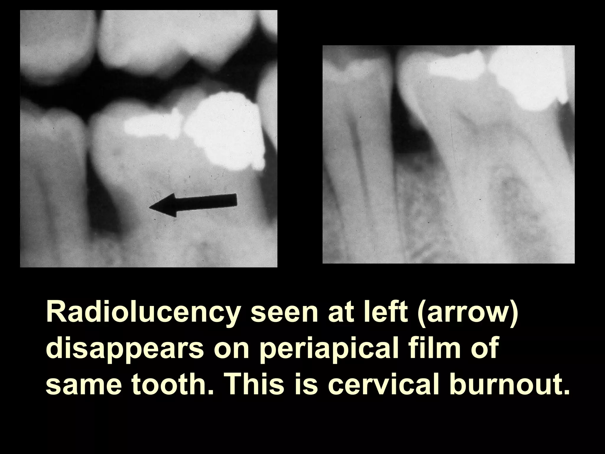 radiographic-caries-diagnosis | PDF