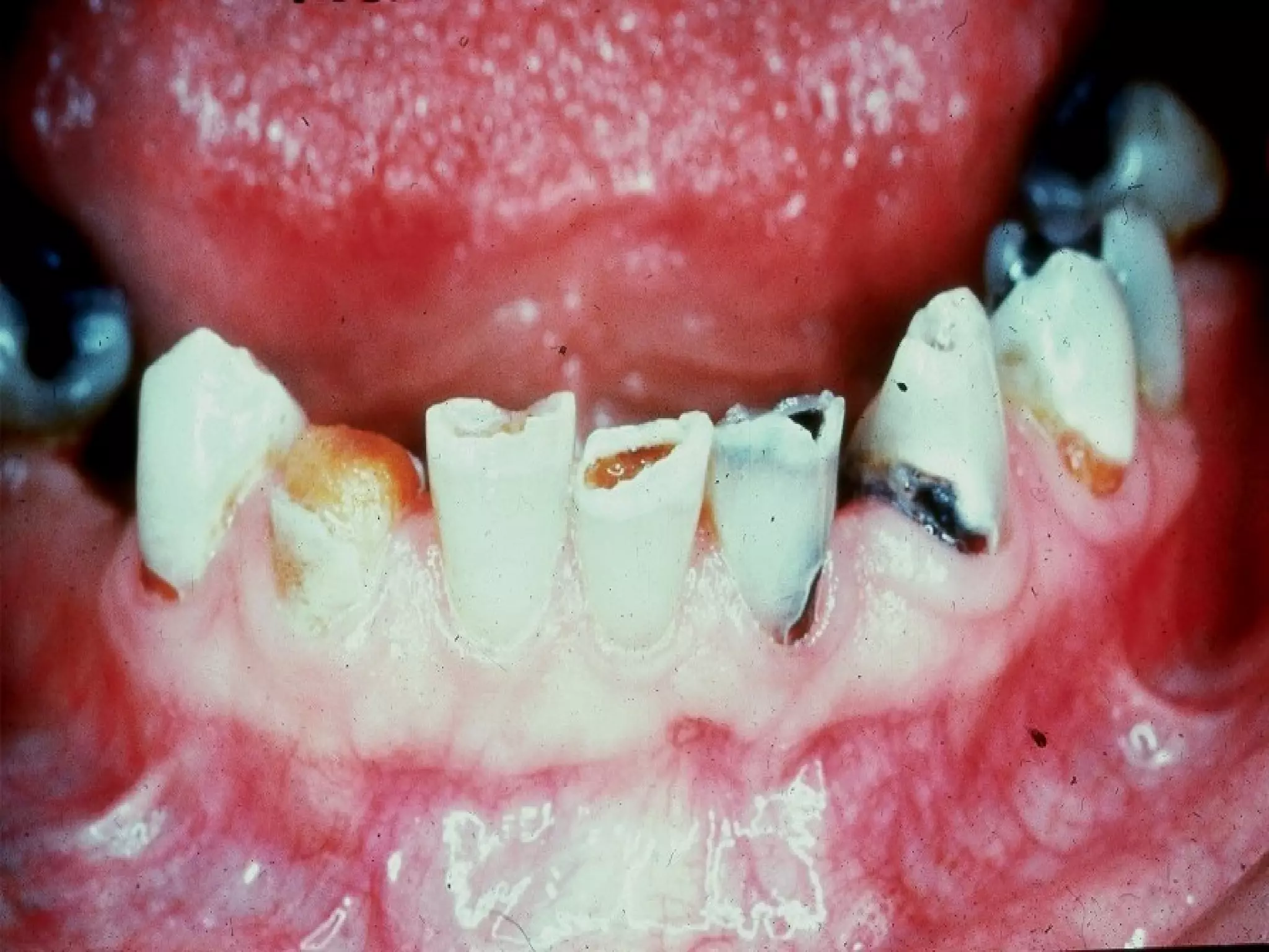 radiographic-caries-diagnosis | PDF