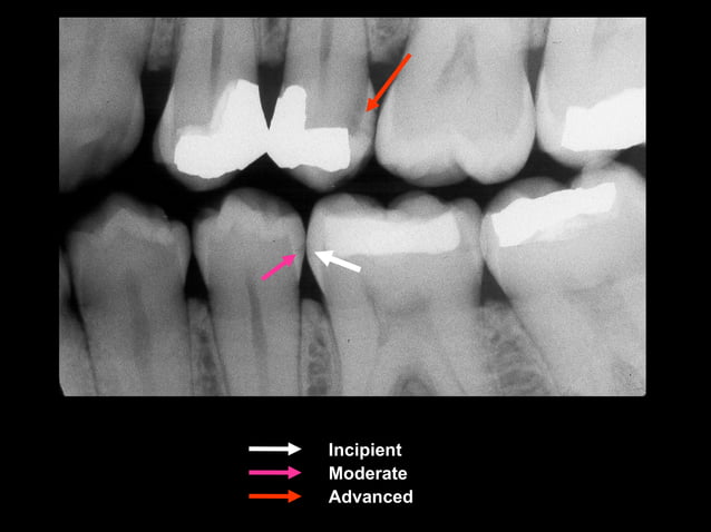 radiographic-caries-diagnosis | PDF | Dental Health | Diseases and ...