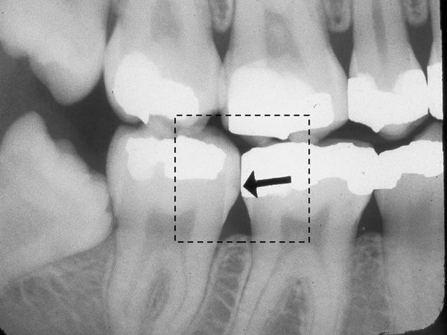 radiographic-caries-diagnosis | PDF | Dental Health | Diseases and ...