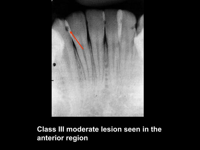 radiographic-caries-diagnosis | PDF | Dental Health | Diseases and ...