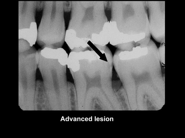 radiographic-caries-diagnosis | PDF | Dental Health | Diseases and ...