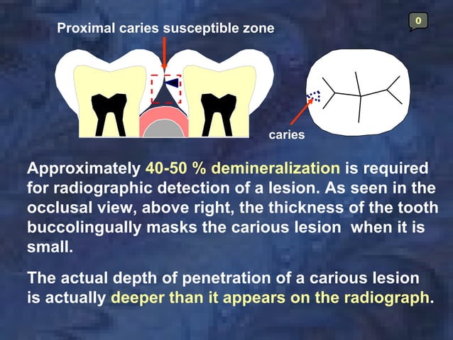radiographic-caries-diagnosis | PDF | Dental Health | Diseases and ...