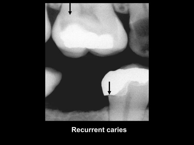 radiographic-caries-diagnosis | PDF | Dental Health | Diseases and ...