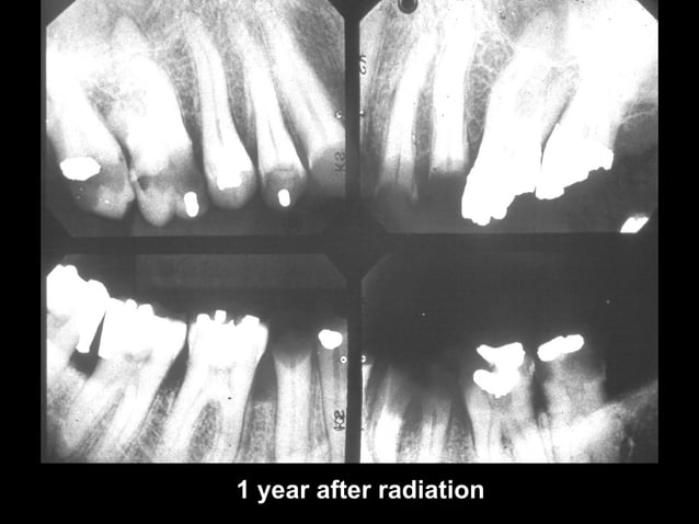 radiographic-caries-diagnosis | PDF | Dental Health | Diseases and ...