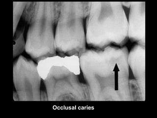 Occlusal Decay