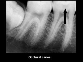 Occlusal Decay