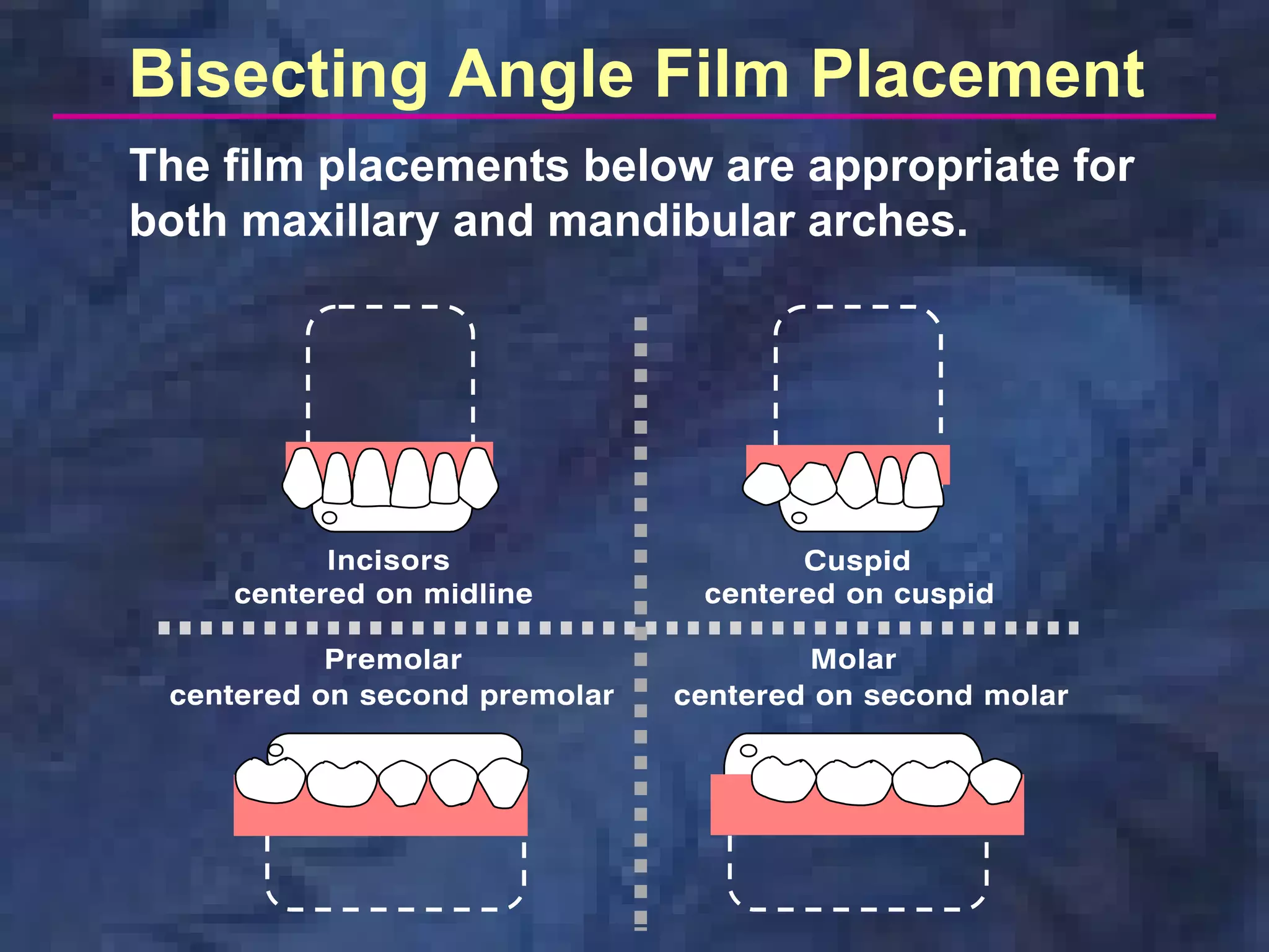 radio-graphic-techniques-bisecting-and-occlusal | PDF