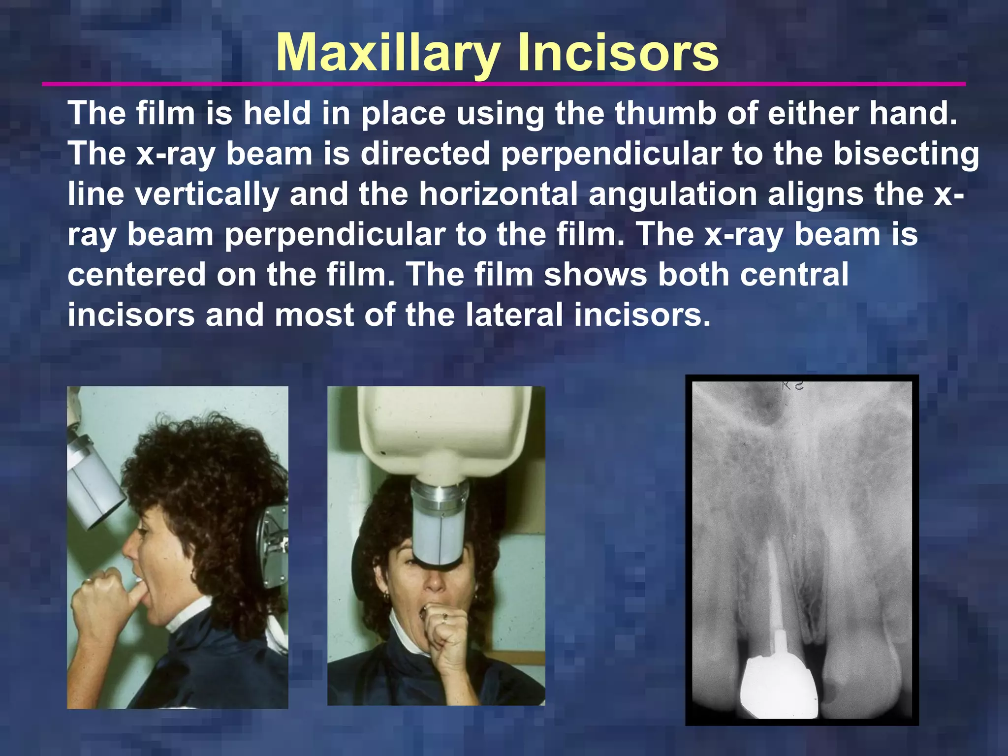 radio-graphic-techniques-bisecting-and-occlusal | PDF