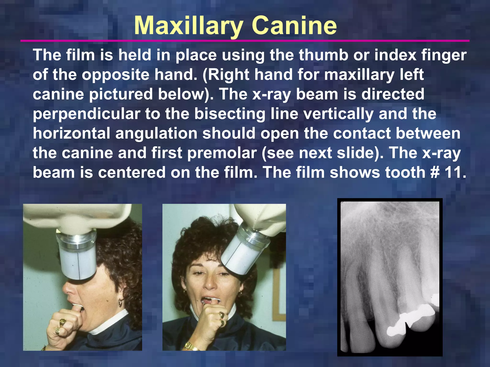 radio-graphic-techniques-bisecting-and-occlusal | PDF