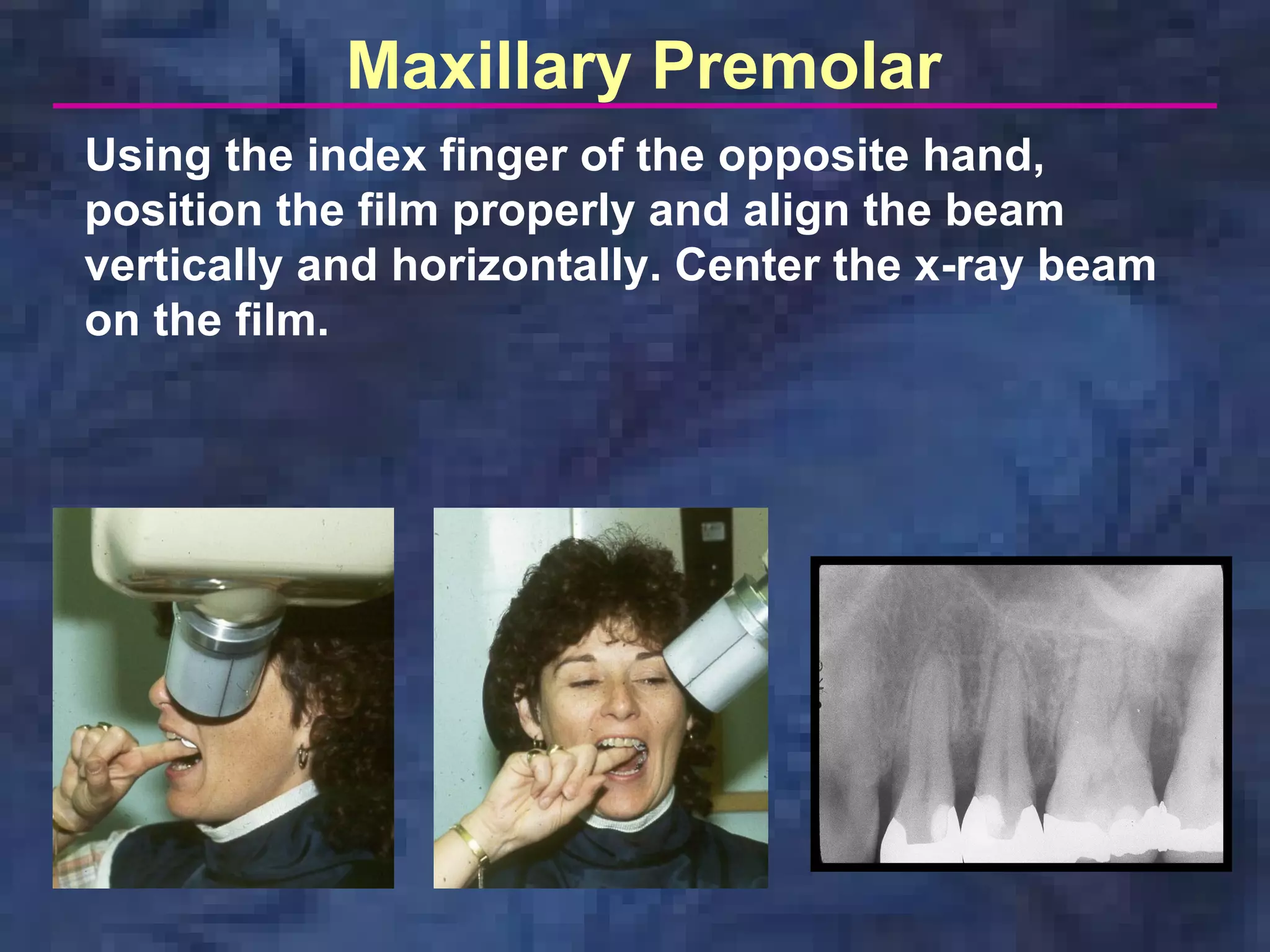 radio-graphic-techniques-bisecting-and-occlusal | PDF
