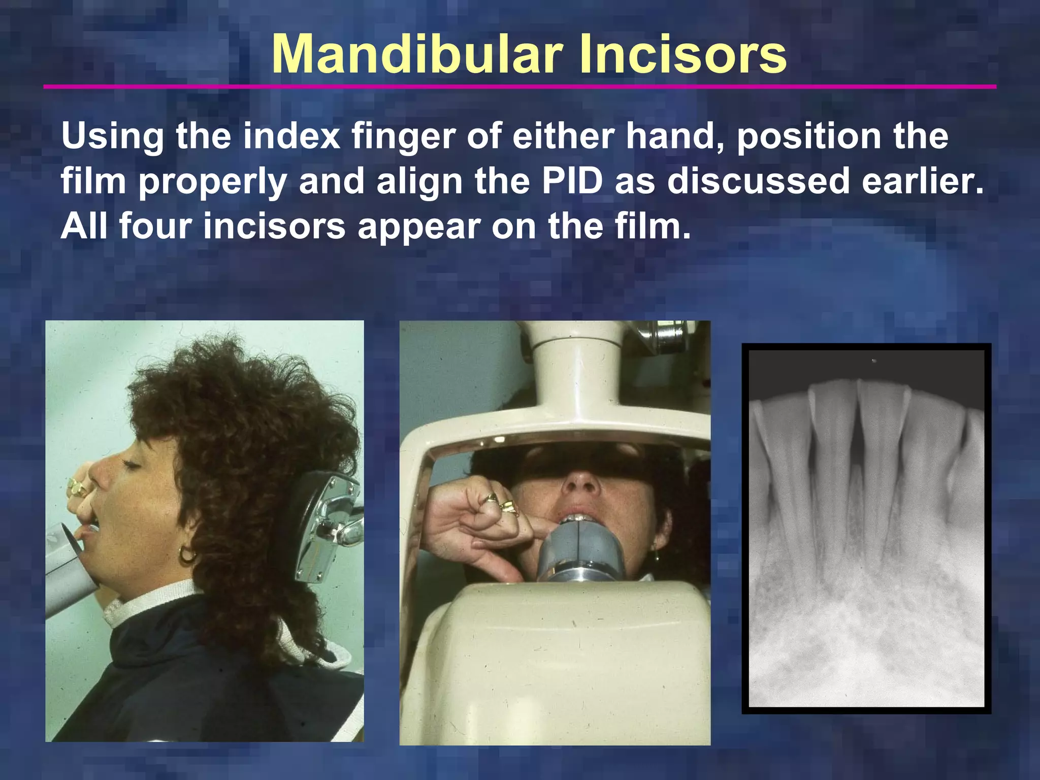 radio-graphic-techniques-bisecting-and-occlusal | PDF
