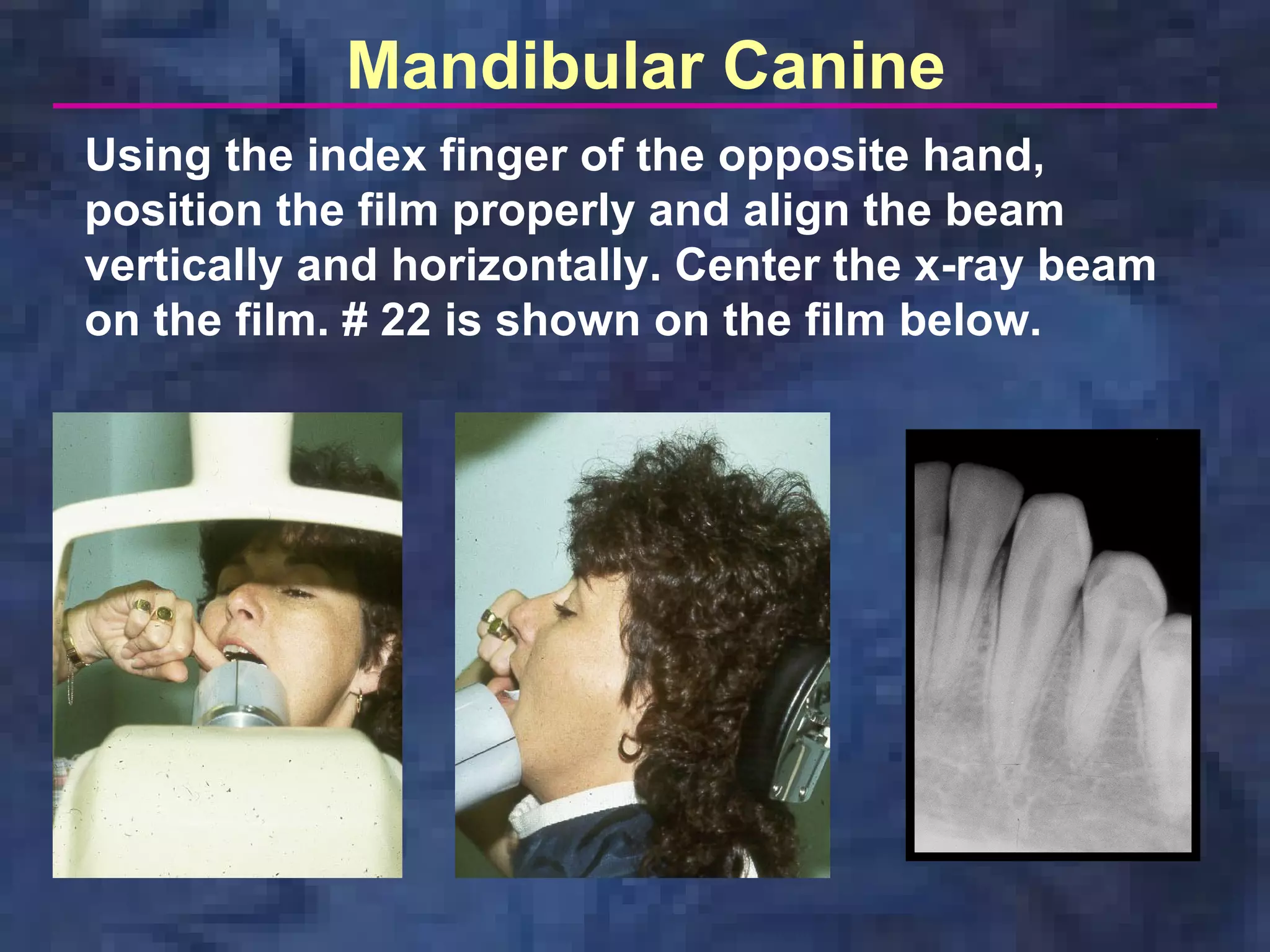 radio-graphic-techniques-bisecting-and-occlusal | PDF