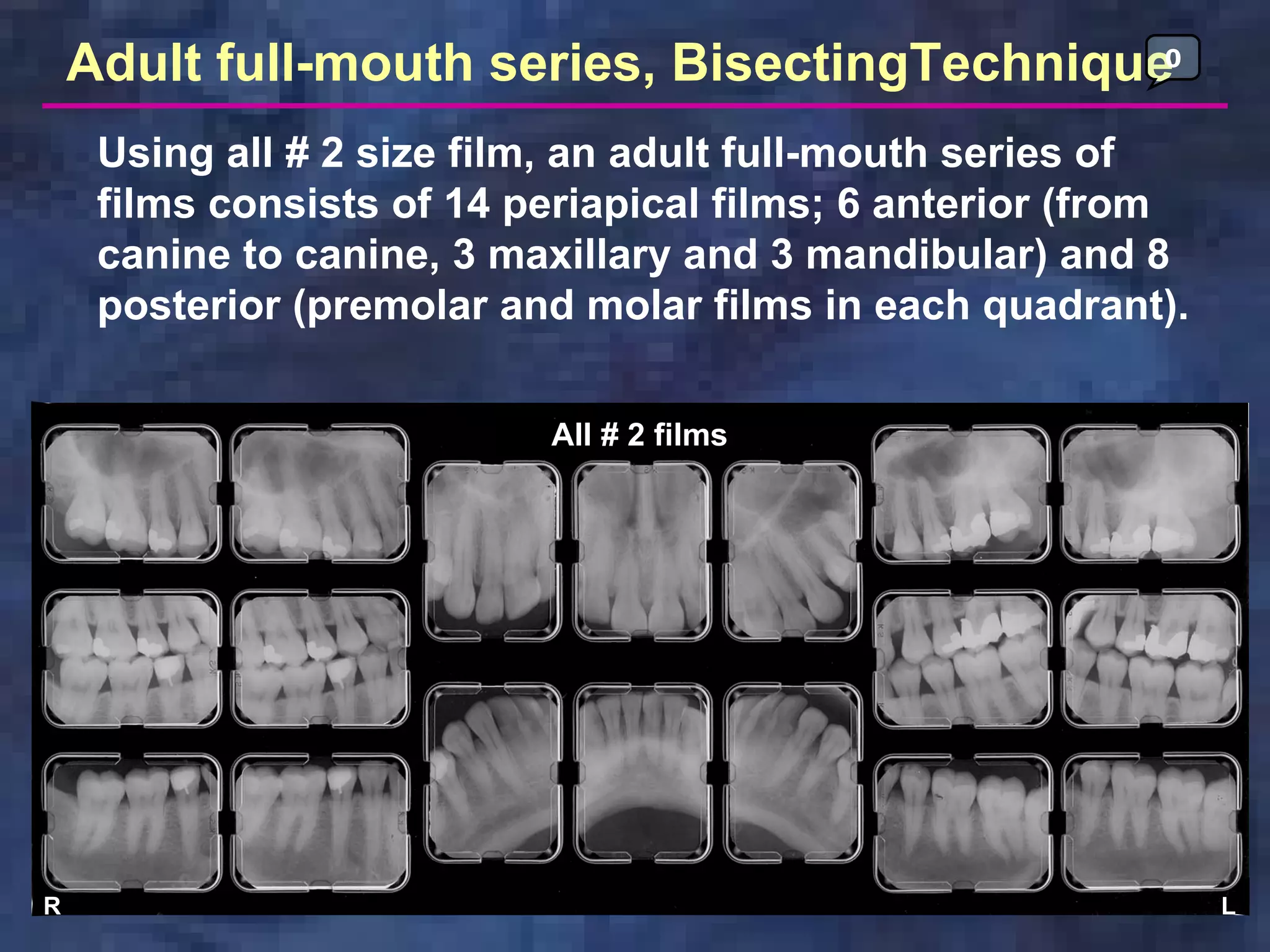 radio-graphic-techniques-bisecting-and-occlusal | PDF