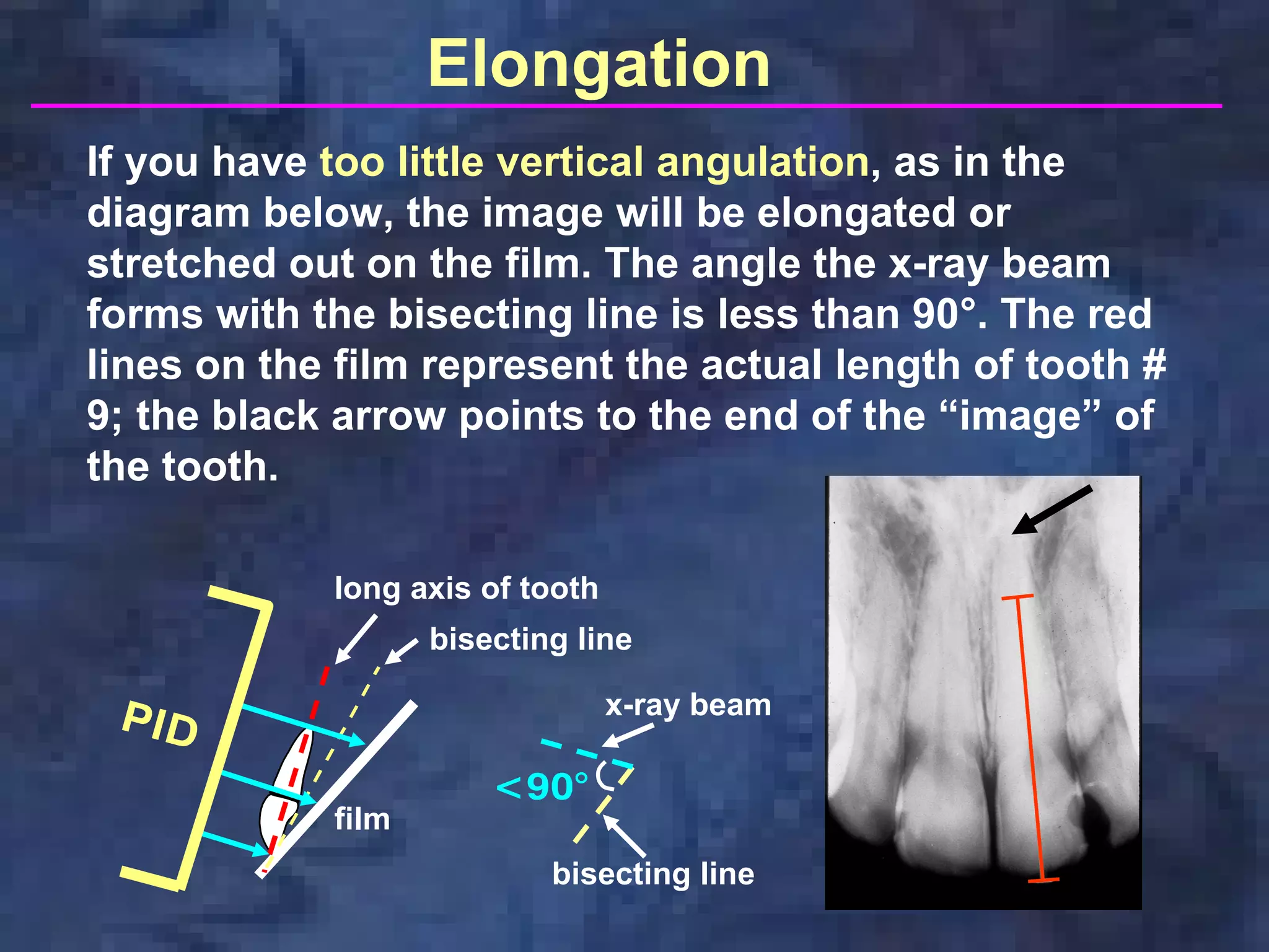 radio-graphic-techniques-bisecting-and-occlusal | PDF