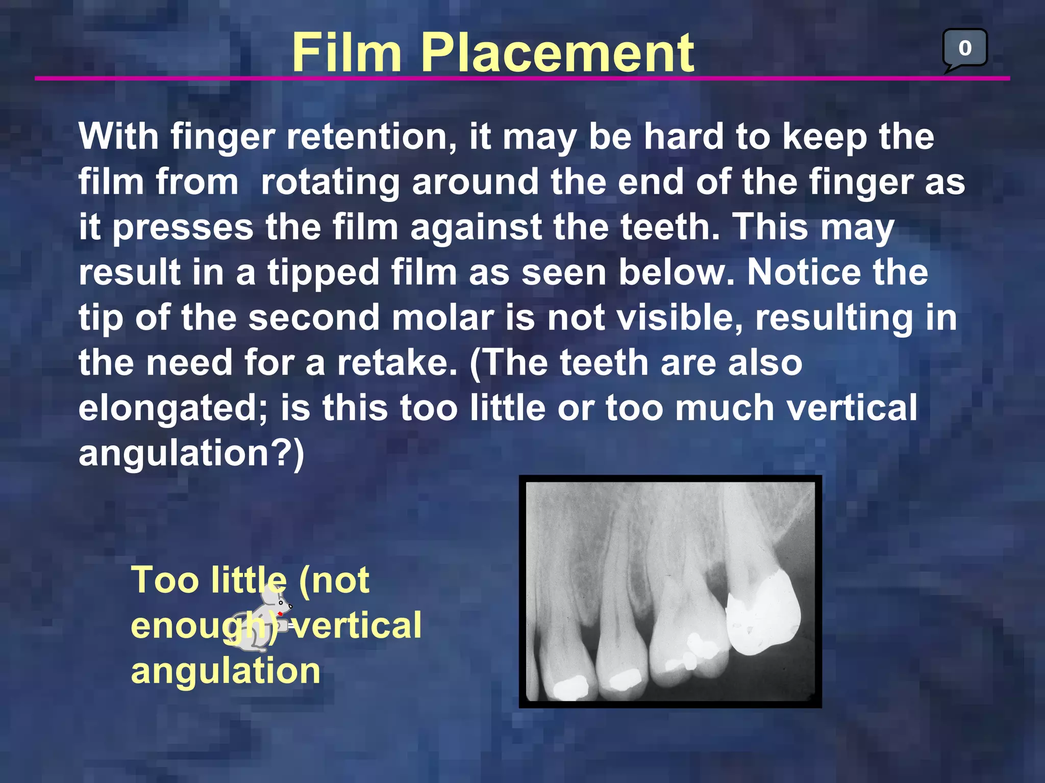 radio-graphic-techniques-bisecting-and-occlusal | PDF