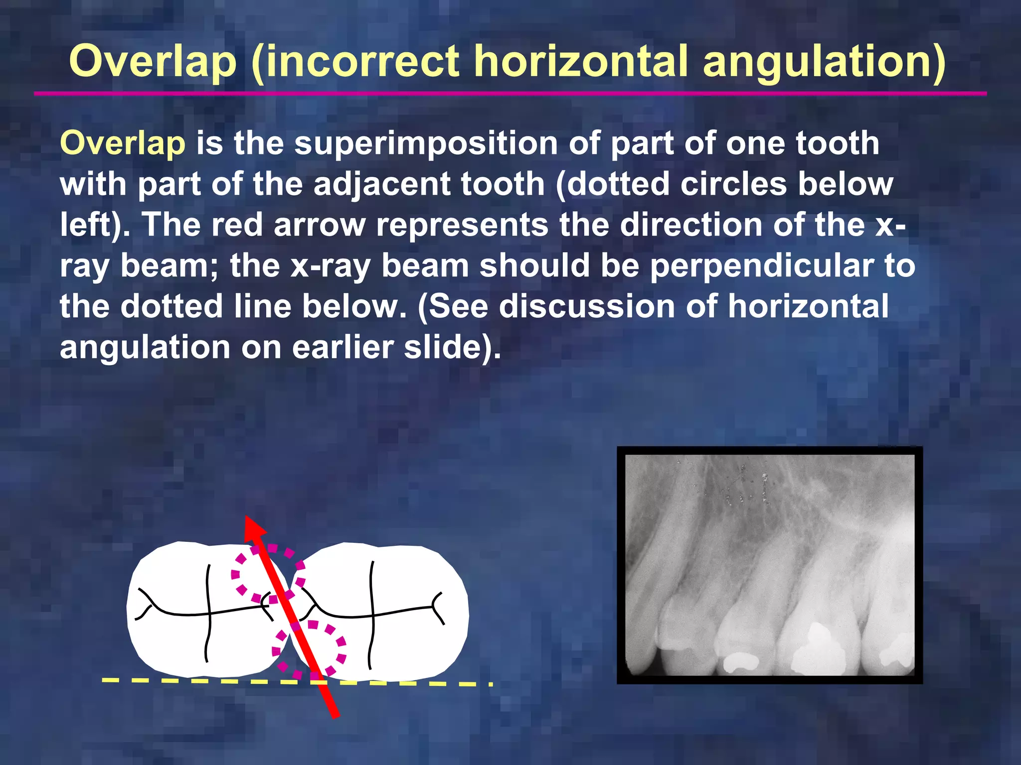 radio-graphic-techniques-bisecting-and-occlusal | PDF