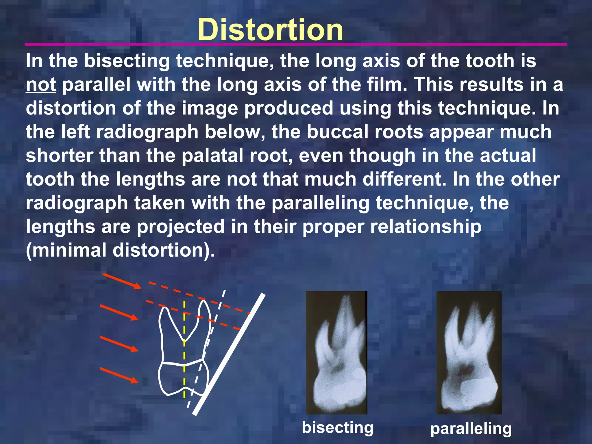 radio-graphic-techniques-bisecting-and-occlusal | PDF