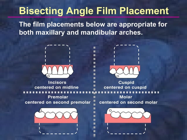 radio-graphic-techniques-bisecting-and-occlusal | PDF | Operating ...